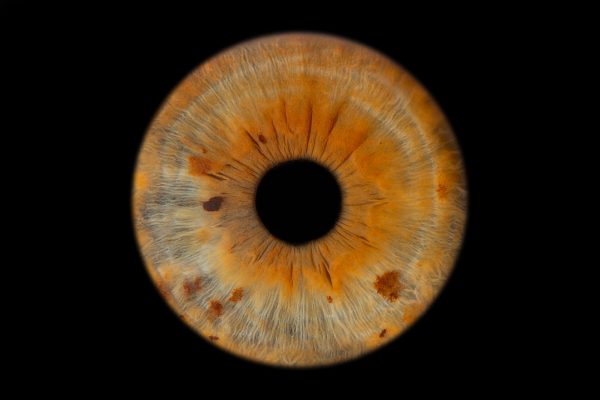 Freckles on the Iris: What Do They Mean?