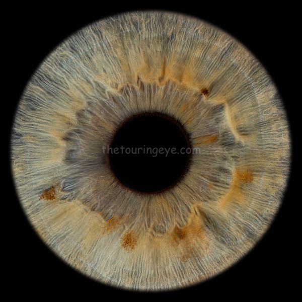 Freckles on the Iris: What Do They Mean?