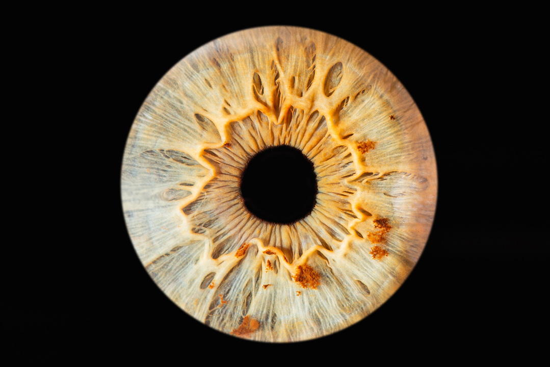 Freckles on the Iris: What Do They Mean?